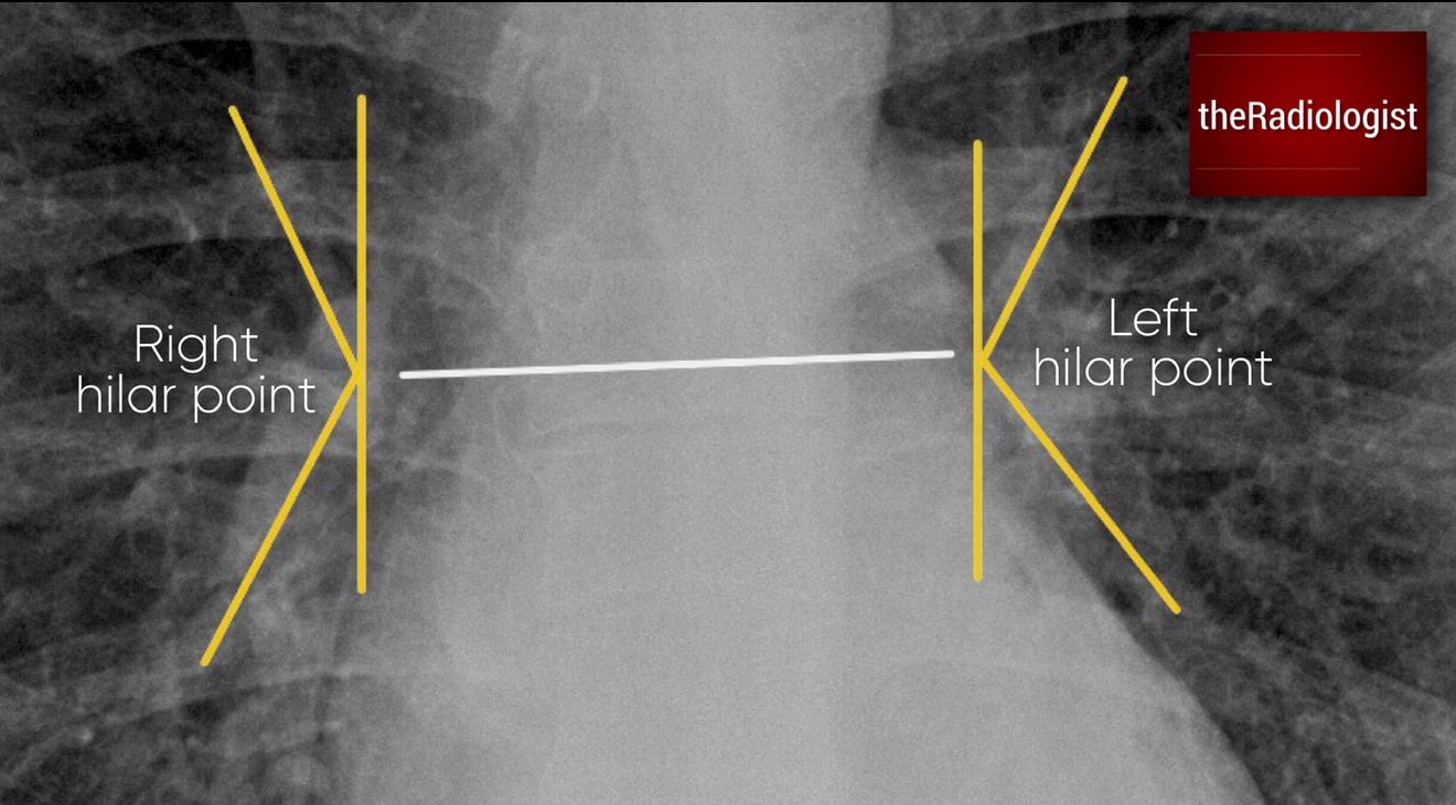 How to Read a Chest X-ray | CXR Interpretation Guide